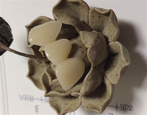 Natural Colour Resin Based Composite Crowns