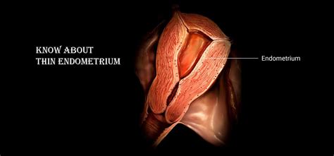Understanding Thin Endometrium Causes Diagnosis And Treatment For