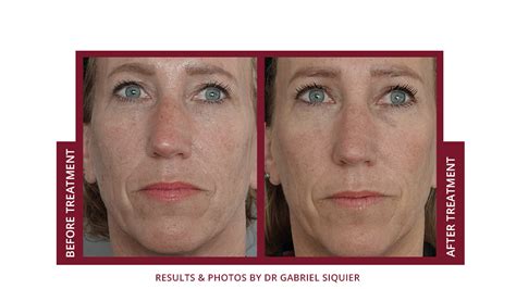 Profhilo® Structura Dameto Clinics International