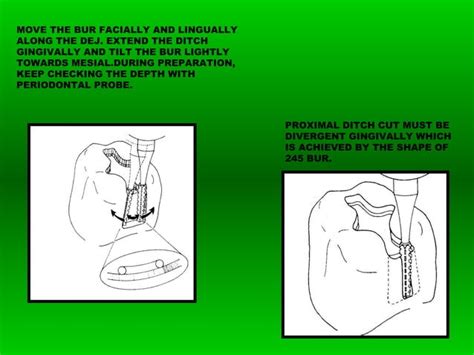 Class Ii Amalgam Preparation Ppt