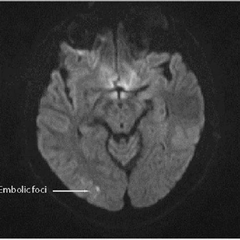 Diffusion Weighted Imaging Sequence Magnetic Resonance Imaging Brain Download Scientific