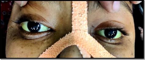 Photograph Showing Icterus Download Scientific Diagram