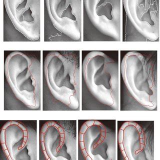 Battlefield Acupuncture Points In Ear Cingulate Gyrus Thalamus Omega