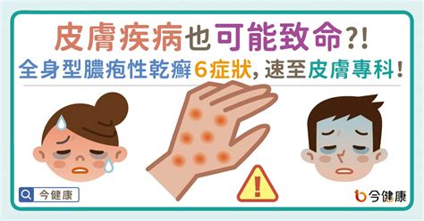 皮膚疾病也可能致命？！全身型膿疱性乾癬6症狀，速至皮膚專科！ 蕃新聞