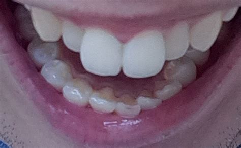 공군사관학교 신체검사 부정교합 지식in