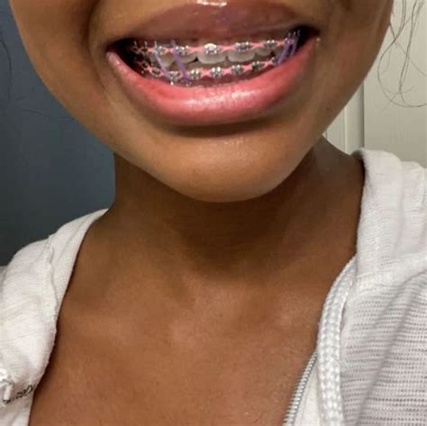 Follow Mwahfeedzz For More Braces Colors 😬🔗 Tags💋 Explorepage