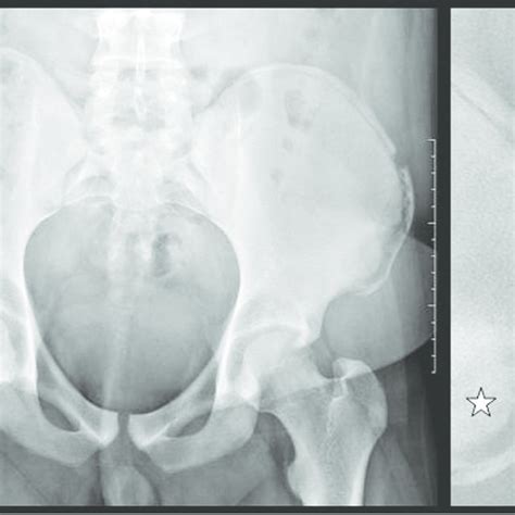 Pdf Acute Avulsion Of The Iliac Crest Apophysis In An Adolescent Indoor Soccer