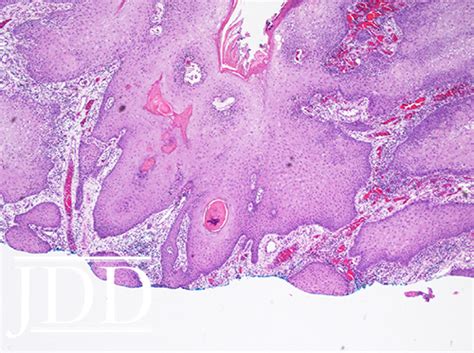 Blastomycosis Like Pyoderma Arising In Lichen Planus A Jdd Case Report Next Steps In Dermatology