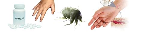 Ivermectin For Scabies Effective Treatment And Dosage Guide Idm