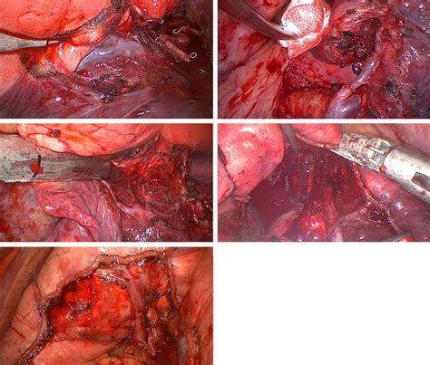 Anterior Basal Segment Of Rll S8 Is Inflated A And Intersegmental