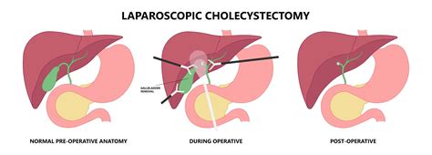 Laparoscopic Cholecystectomy In Turkey Cholecystectomy