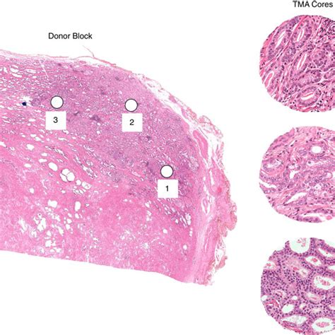 Schematic Showing Sampling For Tissue Microarray Tma Construction