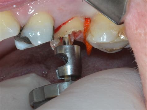 Benex Extraction System