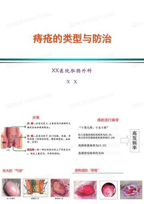 痔疮的分类与防治ppt模板下载 编号lprgdaao 熊猫办公