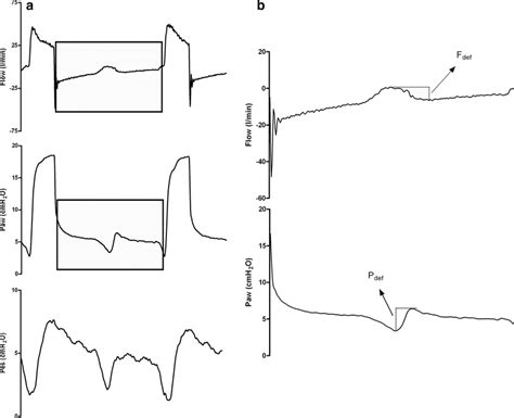 A Demonstration Of Ineffective Triggering In The Expiratory Phase