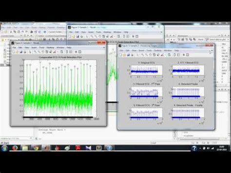 ECG Signal Processing In MATLAB Detecting R Peaks MATLAB Programming