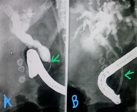 Ercp And Egd Suspected Malignant Biliary Stricture
