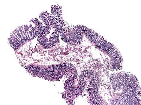Serrated Polyps Quiz