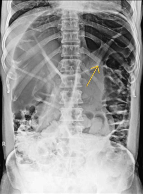 Dr Tushar Dahmiwal On Linkedin A Case Of Redundant Sigmoid Colon And Sigmoid Volvulus