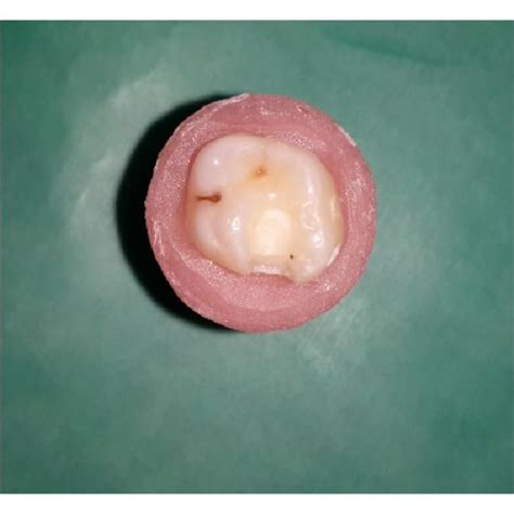 Proximal View Of Inlay Class Ii Preparations A Occlusal View Of Download Scientific Diagram