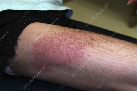 Dermatomyositis Stock Image C060 6596 Science Photo Library