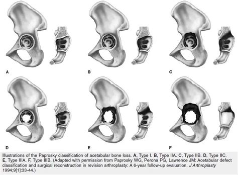 How To Treat Acetabular Defects Part 1
