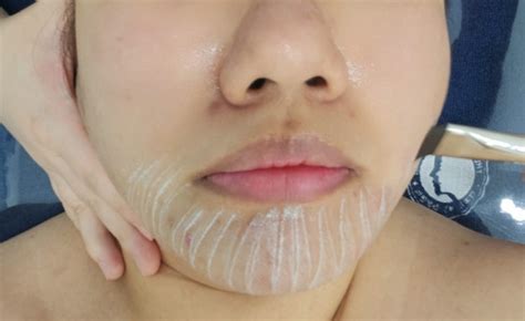 다산피부관리 문제성피부 여드름관리는 더고은피부전문센터 네이버 블로그