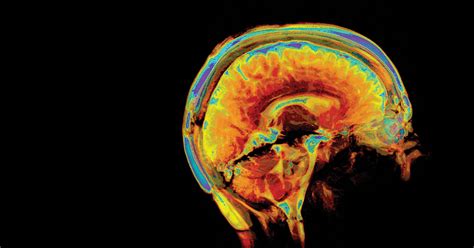 What Is A Functional Neurologic Disorder