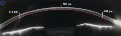 Interface Fluid Syndrome Eyewiki