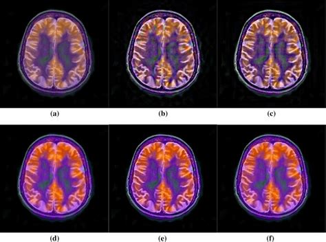 Mri T2 And Spect Ti Image Fusion By Wavelet Transform Nsct Nsct Pcnn