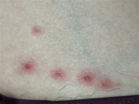 벌레 물린 자국 모기 벼룩 빈대 지식in