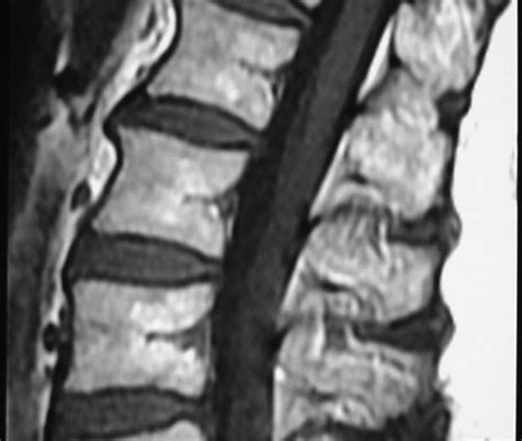 Abnormal D11 Antelisthesis Of L5 S1 Radiopaedia