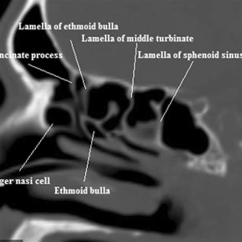 Keros Classification 15 Of The Height Of The Olfactory Fossa A Type