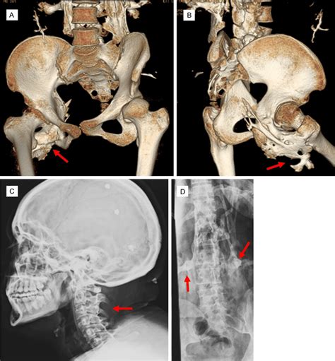 Ct Scan With 3d Reconstruction And Radiographs From Patient 6 A Ct Download Scientific