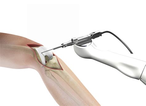 Robotic Assisted Knee Replacement Phoenix Total Knee Arthroplasty