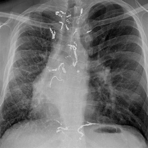Chest X Ray Showing The Result Of Extensive Embolization Of The Download Scientific Diagram