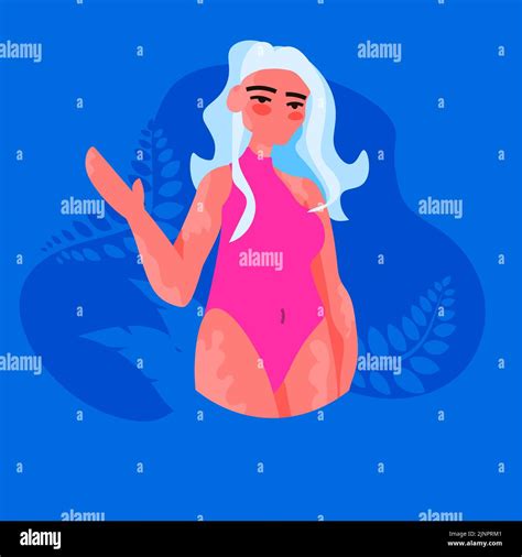 World Vitiligo Day Another Kind Of Beauty Love Yourself Accept Your