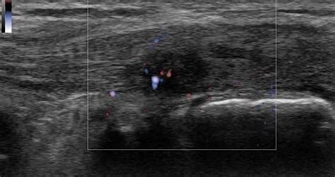 Musculoskeletal Joints And Tendons 6 3 Wrist And Carpus Case 6 3 2 Tenosynovitis Of The
