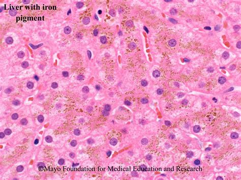 Hemochromatosis Mayo Clinic Proceedings