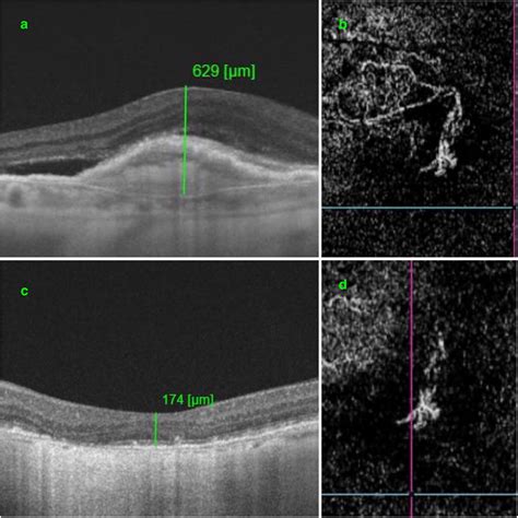 Oct Angiography Biomarkers In Type 1 Choroidal Neovascularisation After
