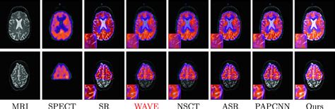 qualitative results of mri and spect image fusion on whole brain atlas