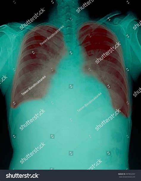 Chest Xray Examination Diagnosis Pulmonary Tuberculosis Stock Photo Shutterstock