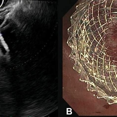 Eus Guided Cystgastrostomy Deployment Of Lumen Apposing Metal Stent Download Scientific