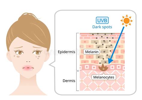 UVB Radiation Penetrate Into The Skin On Womans Face That Is Associated With Dark Spot Beauty