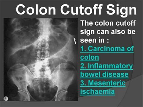 Sentinel Loop Sign X Ray At Charles Gilley Blog
