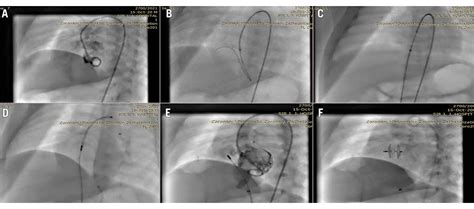 Percutaneous Device Closure Of A Perimembranous Ventricular Septal
