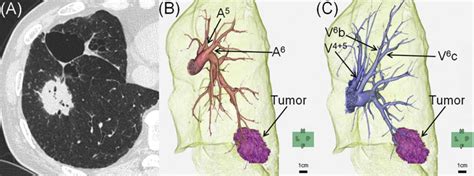 Thoracoscopic Right Basilar Segmentectomy After Right Upper Lobectomy The Annals Of Thoracic