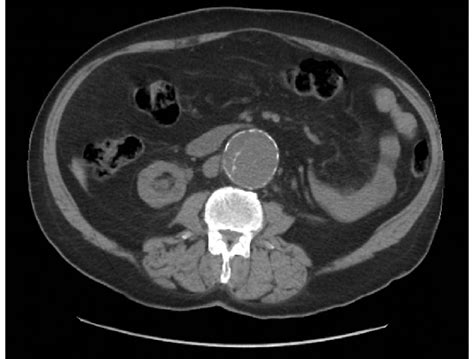Ct Scan From 2017 With Contrast Illustrated Infrarenal Abdominal Aortic Download Scientific