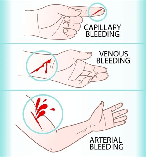 5 Capilar Bleeding Royalty Free Photos And Stock Images Shutterstock
