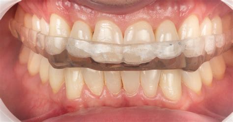 Bruxismo Qual O Tratamento Dr Renato Sartori Odontologia Digital